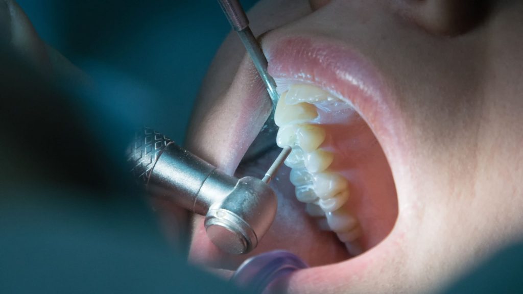 ¿Cómo saber cuando necesitas una endodoncia? - Clínica La Victoria
